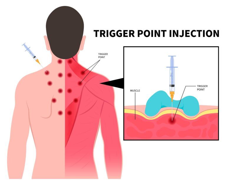 Trigger Point Injections in New Jersey - NJ Pain Care Specialists